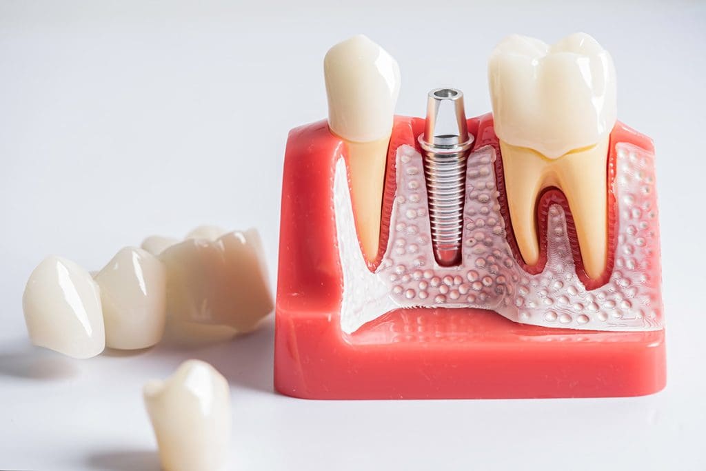 Quanto costa un impianto dentale? Guida ai prezzi