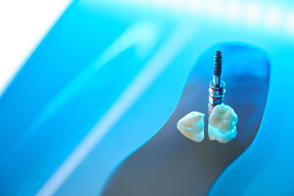 Impianto Dentale in Titanio: Costi, Durata e Benefici